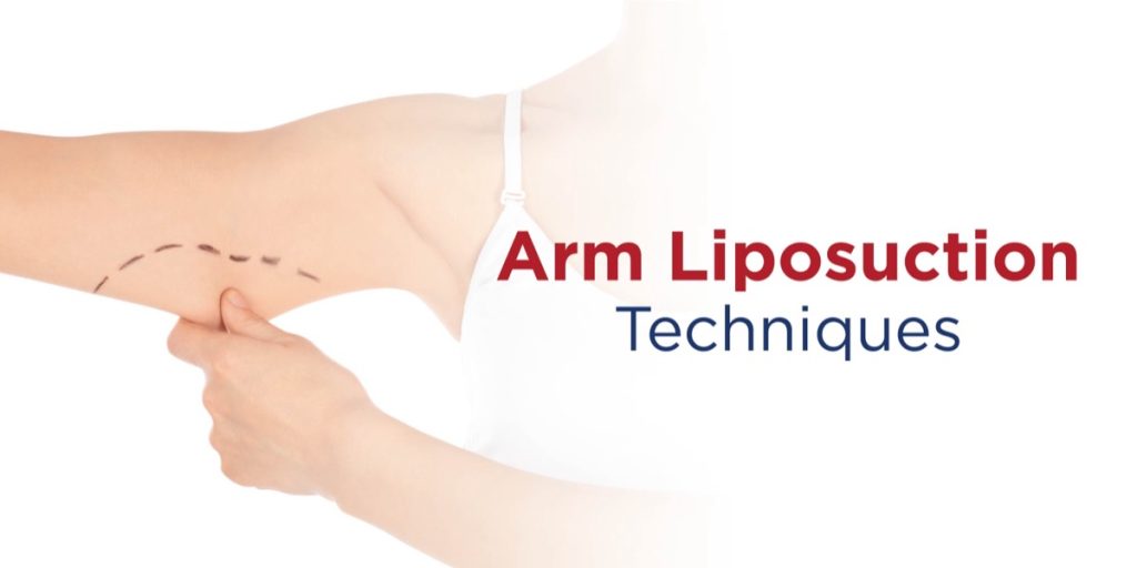 Arm Liposuction - PPSI